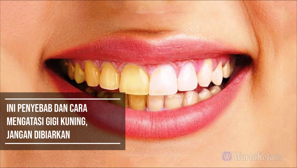 Ini Penyebab dan Cara Mengatasi Gigi Kuning, Jangan Dibiarkan